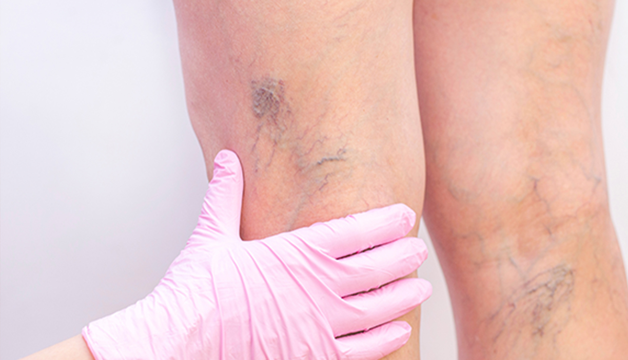 The Power of Endovenous Radiofrequency - Medicart Ottawa